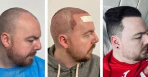 Temporal Point Hair Loss: Causes, Treatments & Expert Advice