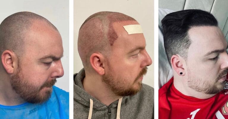 Temporal Point Hair Loss: Causes, Treatments & Expert Advice