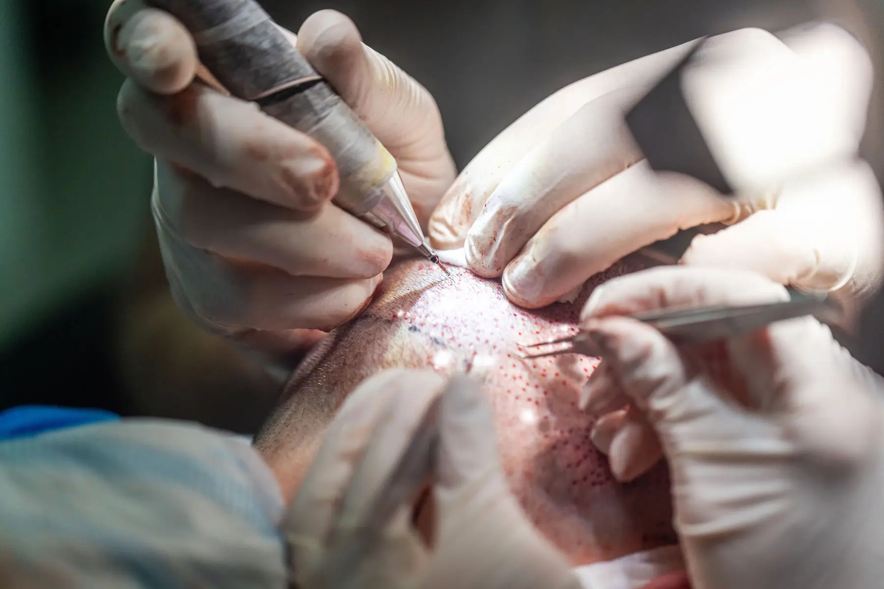 FUE Hair Transplant in Wales, UK | Dr. Ted Hair Transplant